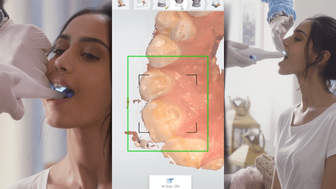 toothsi Aligners: Fix Teeth Misalignment with Clear Aligners at Home