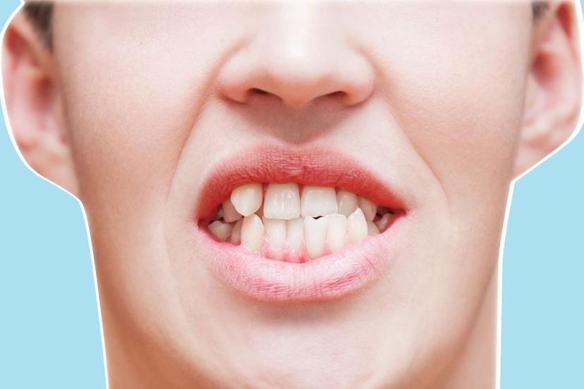 Crossbite Teeth: Causes and How to Treat It?
