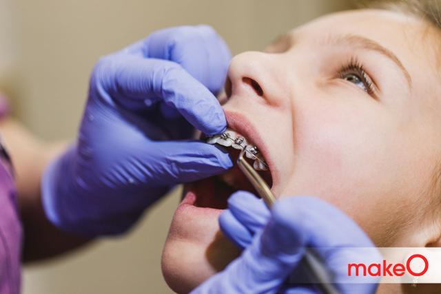 Blog Oral Care What Is Orthodontic Headgear Types Cost And Uses | MakeO