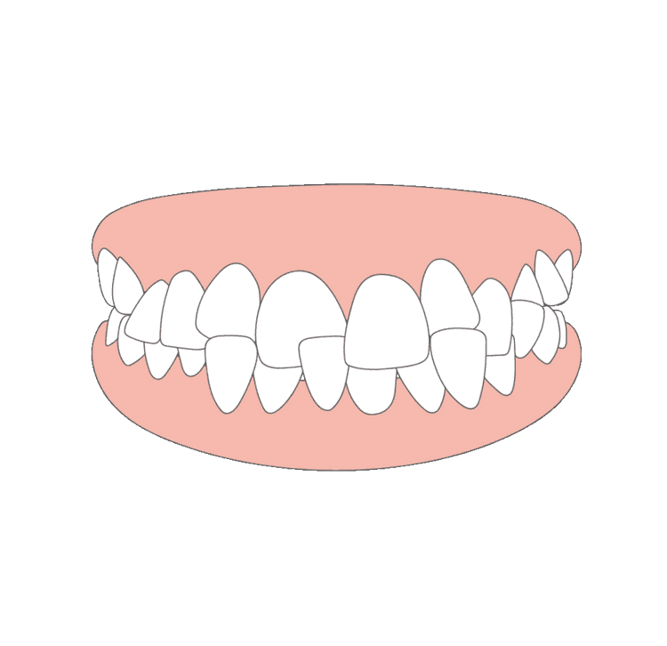 Invisible Aligners & Braces for Kids or Teenagers | Tootshi