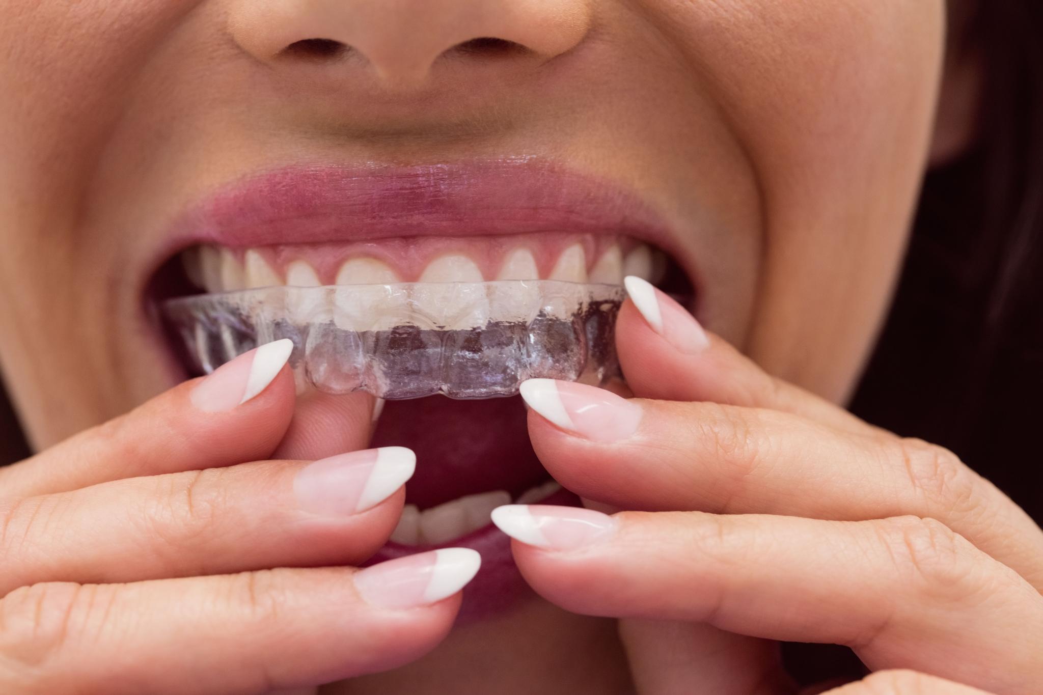 makeO toothsi Aligner Uses and Benefits You Should Know About