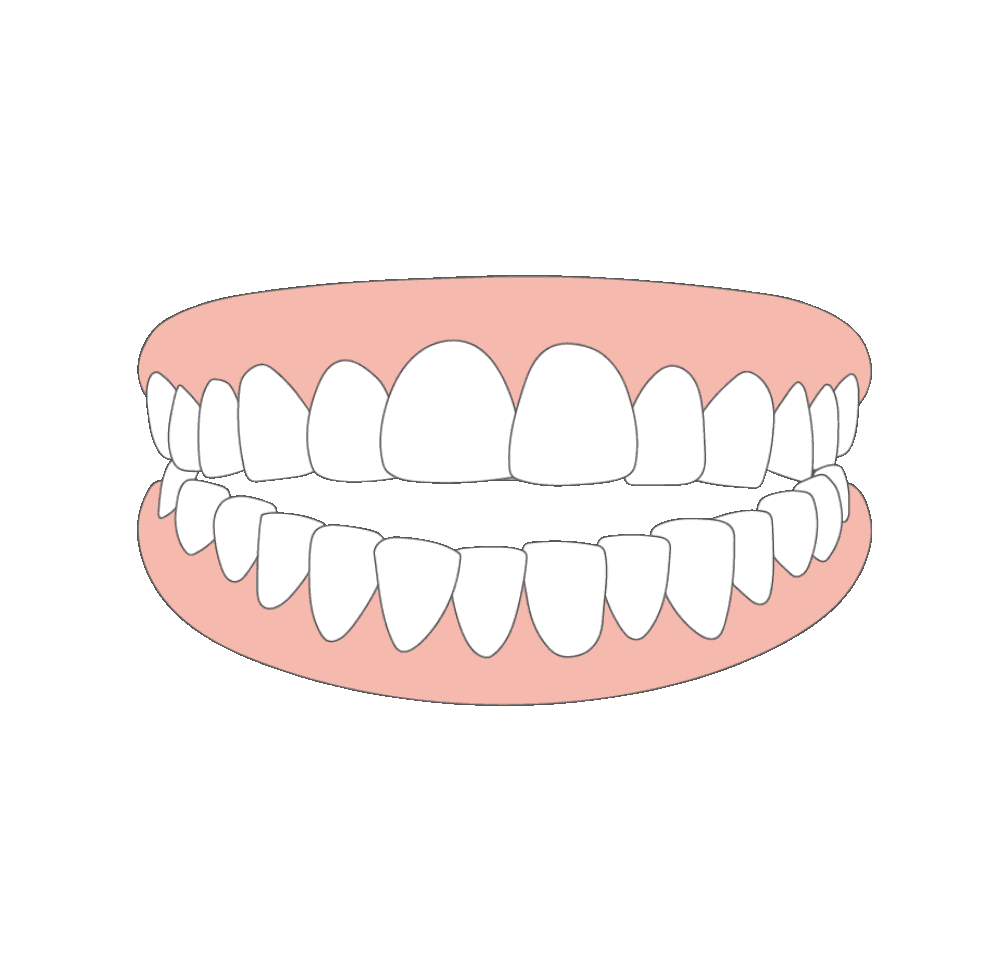 Aligners: Clear, Transparent, Invisible Teeth Aligners - MakeO Toothsi