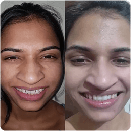 toothsi Reviews, Customer Teeth Treatment Results & Feedback | makeO ...