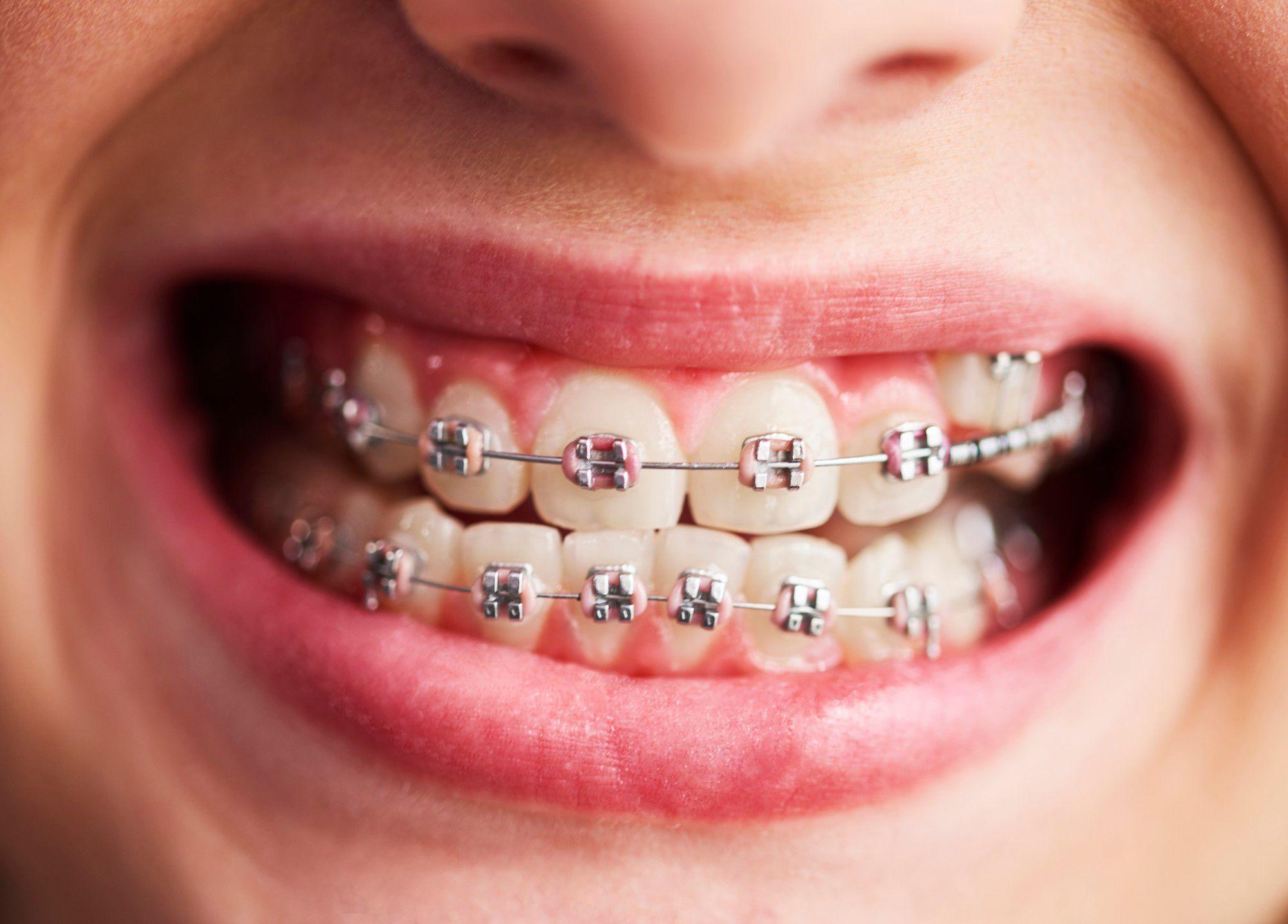 Toothsi Bangalore: Orthodontic & Aligners Treatment